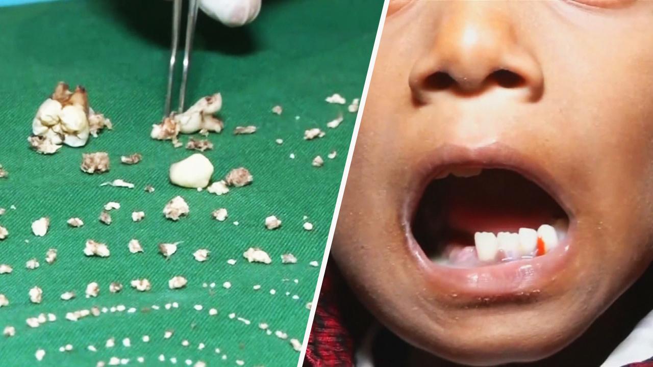 Doctors Remove Over 500 Teeth From 7 Year Old Boy's Mouth - KQ98